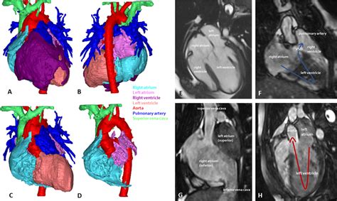 Anatomy Of Double Inlet Left Ventricle Patient 2 A Anterior View Download Scientific