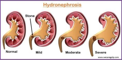 Hydronephrosis