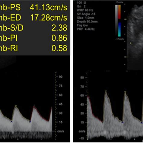 Doppler Ultrasonography The Pulsatility Index Pi And Resistance Download Scientific Diagram