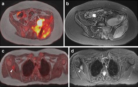 Staging Of Metastatic Ewing Sarcoma In A 12 Year Old Girl A Fused Download Scientific Diagram