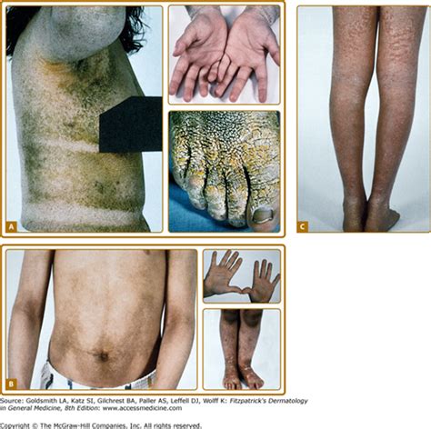 The Ichthyoses Plastic Surgery Key