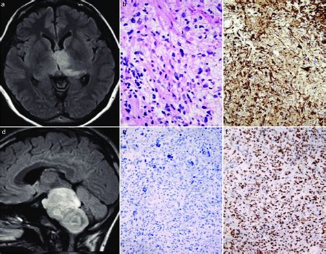 Diffuse Midline Glioma H3 K27M Mutant A Axial FLAIR MRI Shows An Download Scientific