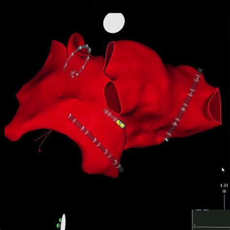 Protocol For High Power Short Duration Technique