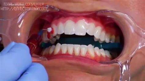 Шүд цайрууалалт гэж юу вэ Амны хөндий дэх бактерууд тамхины никотин зэрэг нь удаан хугацаанд