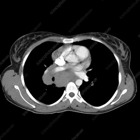 Lung Cancer Ct Scan Stock Image C0584502 Science Photo Library