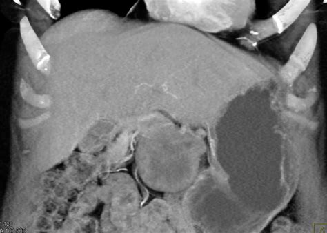 Gist Tumor Off Gastric Antrum Stomach Radiology Case Studies Ctisus Ct Scanning Gist Tumor Off Gastric Antrum Stomach Radiology Case Studies Ctisus Ct Scanning