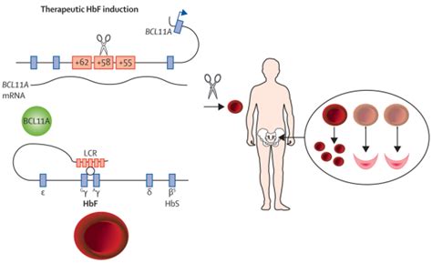 Nat Med β 地中海贫血患者的福音！单碱基编辑技术治疗β 地中海贫血和镰刀状贫血疾病 知乎