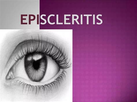 Episcleritis And Uveitisppt Eye Disorders Pptx