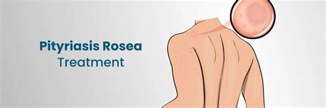 Pityriasis Rosea Stages Causes Treatment Health Blog