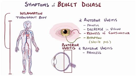 Behcets Disease Video Anatomy Definition Function 51 Off