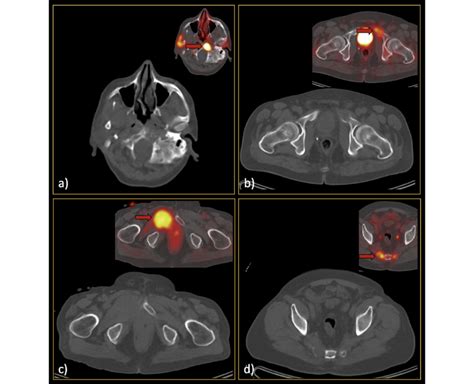 Examples Of The Typical Bone Metastases A D With The Detected Download Scientific Diagram