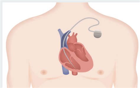 Permanent Pacemaker Implantation Drshrikant