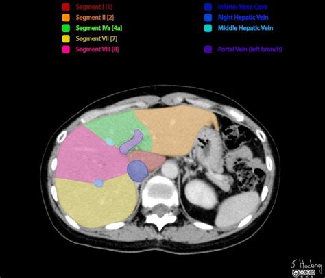 Liver Segments Annotated Ct Radiology Case