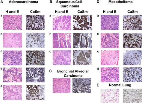 Icd 10 Code For Emphysema With Exacerbation