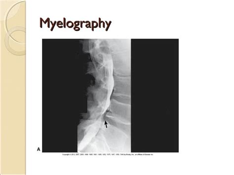 Myelogram Rad 205 2011 Ppt