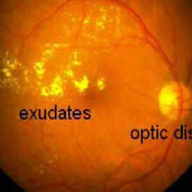 Normal And Abnormal Retinal Image Download Scientific Diagram