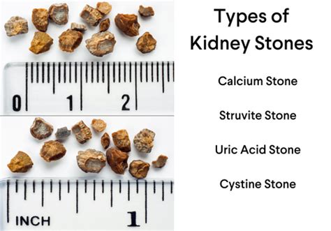 Calcium Stones