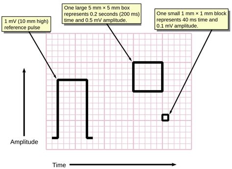 Understanding The EKG Signal Atrial Fibrillation Resources For PatientsAtrial Fibrillation
