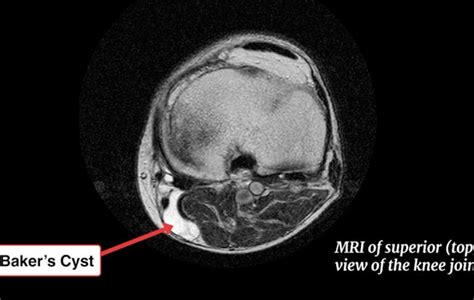 Two Cysts Around The Knee