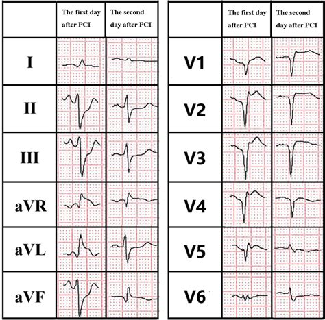อันดับหนึ่ง 99 ภาพ St Elevation คลื่น ไฟฟ้า หัวใจ ผิด ปกติ ครบถ้วน