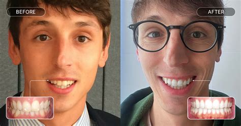 Severe Overbite Smile