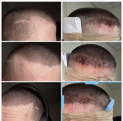Day 1 Hair Transplant 1907 Grapjs Rtressless