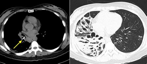 Foreign Body Induced Bronchiectasis Radiology Cases