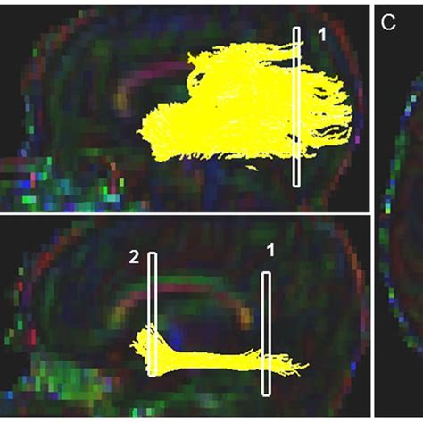 Location Of Single Roi On Dti Color Maps For The Corpus Callosum Cc Download Scientific
