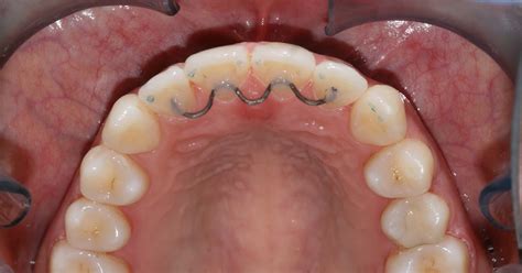 Sessions Ortho Blog Orthodontic Bonded Retainer For The Maxillary Arch