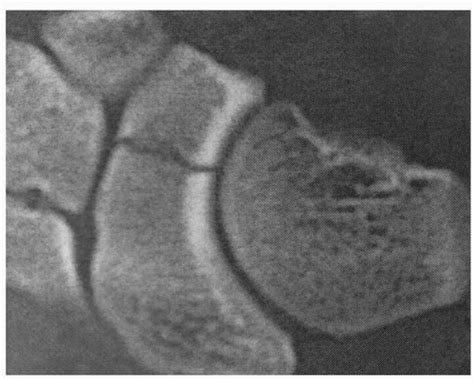 Navicular Stress Fractures Musculoskeletal Key