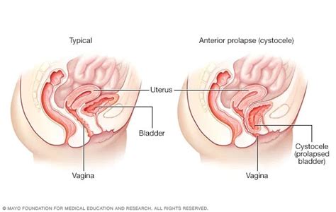 Cystocele Midline