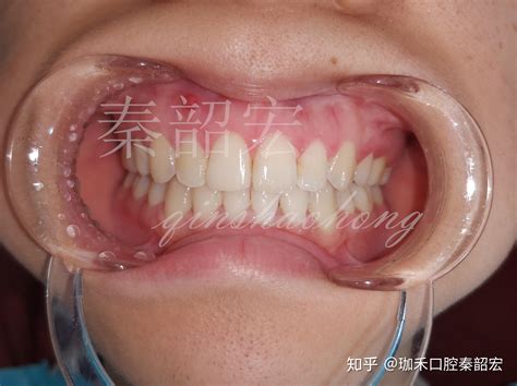 什么是正常的咬合 知乎