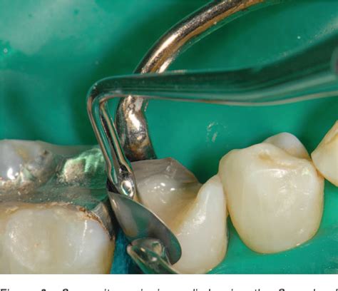 Figure 6 From Proximal Box Elevation With Resin Composite And The Dogma