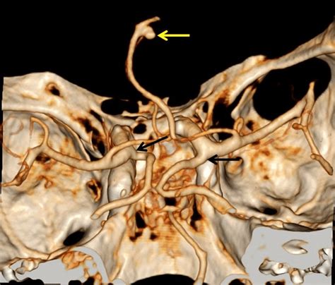 The Image Shows The Presence Of Aneurysm Of Right A2 Segment Of The