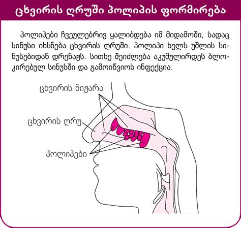 ცხვირის პოლიპები მკურნალი გე