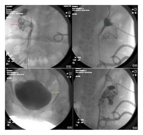 Preoperative Cystoscopy With Bilateral Retrograde Pyelograms Shows A Download Scientific