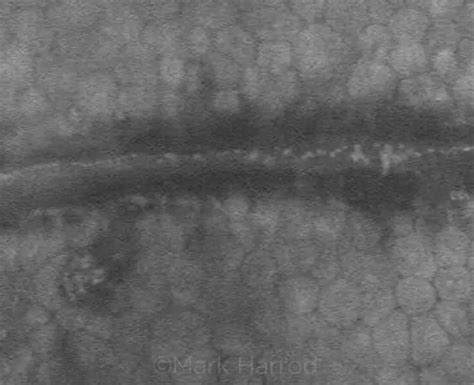 Posterior Polymorphous Corneal Dystrophy American Academy Of Ophthalmology