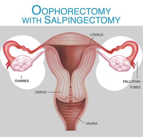 Hysterectomy Oophorectomy