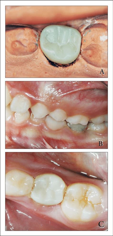 Case Two A Composite Resin Crown Prepared On The Working Model B Download Scientific