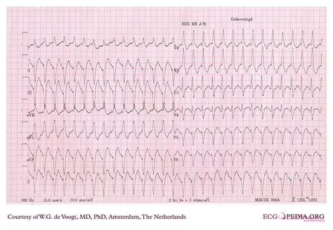 What Are The Shockable Heart Rhythms At Dawn Wilkerson Blog