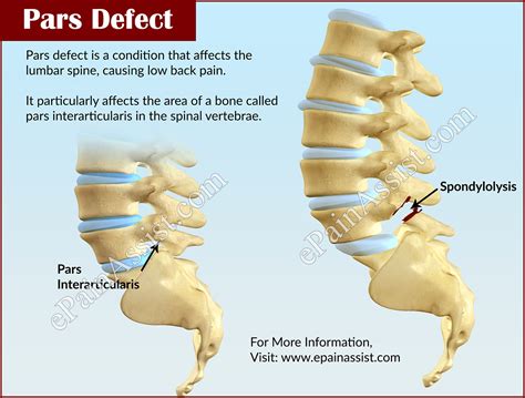 Pars Defect Causes Symptoms Treatment Exercise Diagnosis Prevention