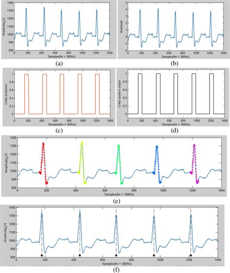 QRS Detection In ECG Signal Using The Proposed Method The Blue Solid