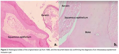 Epidermal Inclusion Cyst Histology Epidermal Inclusion Cyst Histology