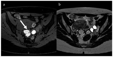 Magnetic Resonance Imaging Of Endometriosis The Role Of Advanced