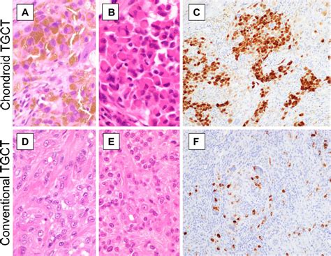 Nosologic Reappraisal Of The Recently Proposed Calcified Chondroid Mesenchymal Neoplasm Concept