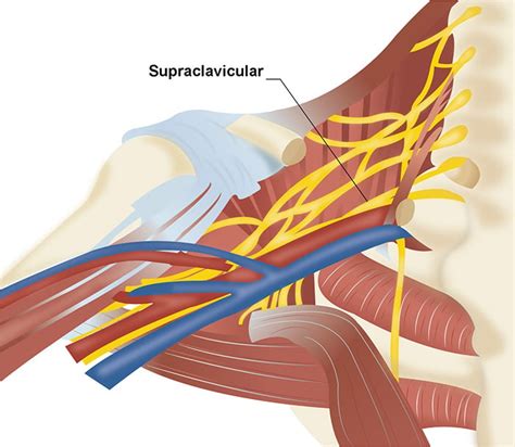 Brachial Plexus Block