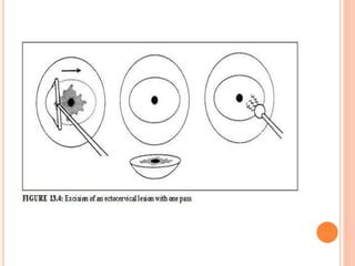 Loop Electrosurgical Excision Procedure PDF
