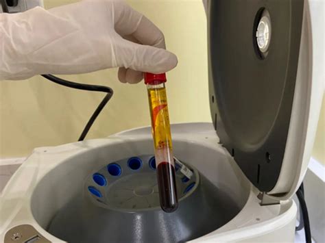 prp血清宫腔灌注治疗子宫内膜薄一般多久能见效 名医在线