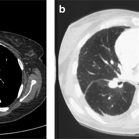 Lung Perfusion Scan In Cteph Showing Homogeneous Ventilation And