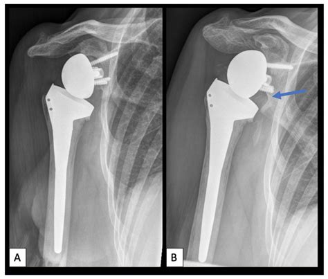 Scapular Notching A Anteroposterior Radiograph Of A Right Shoulder Download Scientific